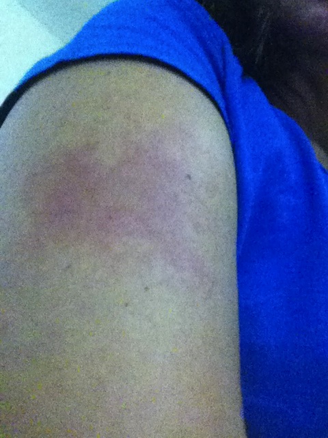 Age 54: Purpura…prednisolone…moon face…bring it on! – Dr. Myriam- The ...